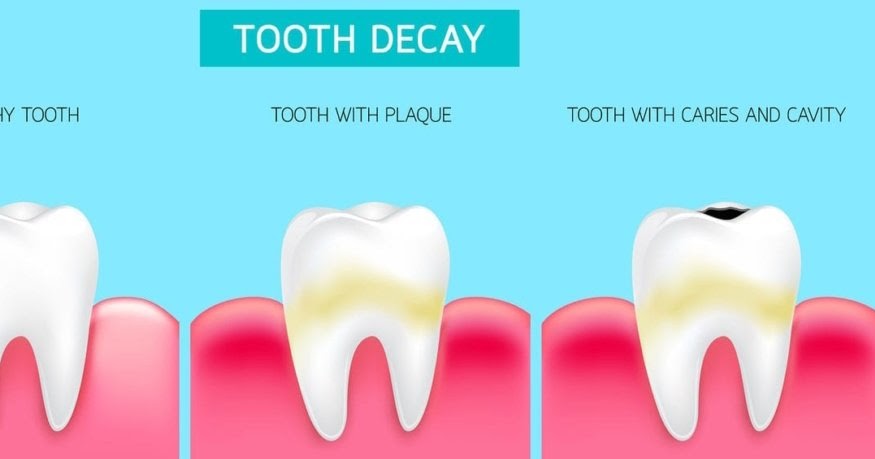 The Dentistry Tech's: What Causes Tooth Decay And How They Develop!