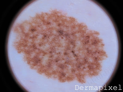 Dermapixel: mayo 2013