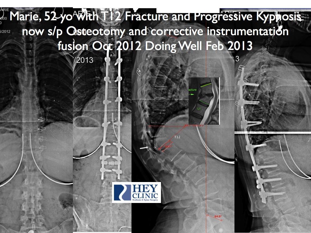 Dr. Lloyd Hey's Blog: Scoliosis and Spine Care, Aviation Safety and ...