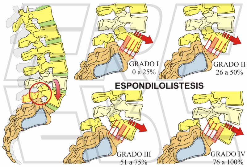 Fisiohipótesis: Patología común del raquis lumbar