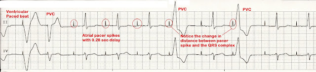 EKG Rhythm Strip Quiz 50