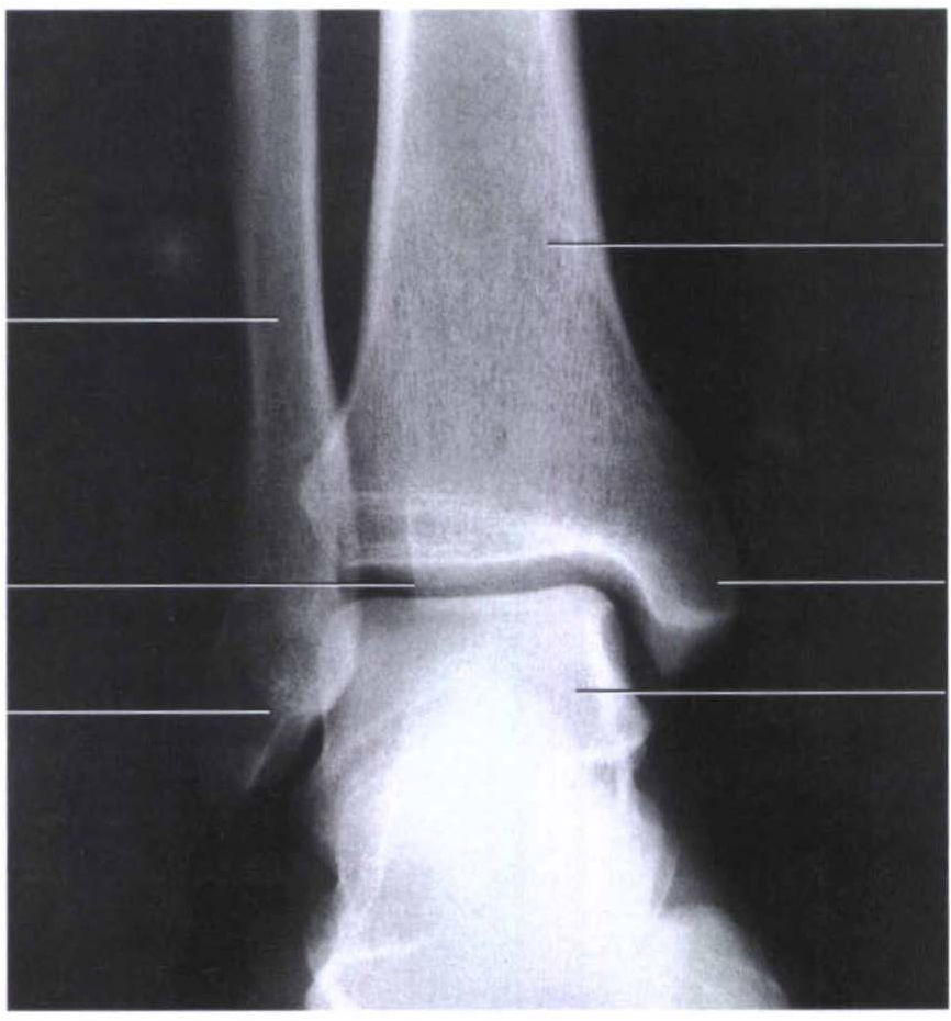 TEKNIK RADIOGRAFI ANKLE JOINT - Radiografer