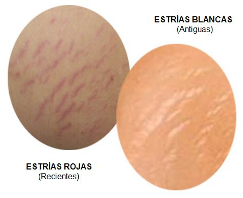 TODO LO QUE NECESITAS SABER DE LAS ESTRIAS - Seduce con la mirada by Cris