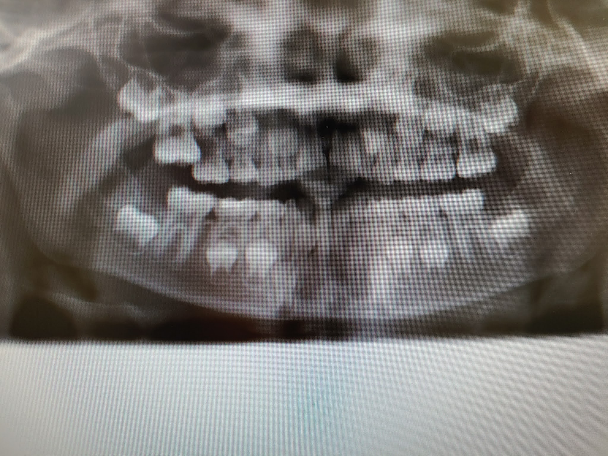 Xray Of Baby Teeth