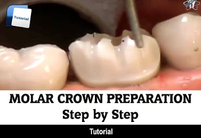 TOOTH REDUCTION: Molar Crown Preparation - Step by Step - Odonto-Tv
