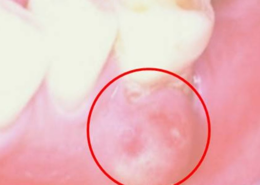 Abses Periodontal: Penyebab, Gejala, Diagnosa, Pengobatan, Pencegajan ...