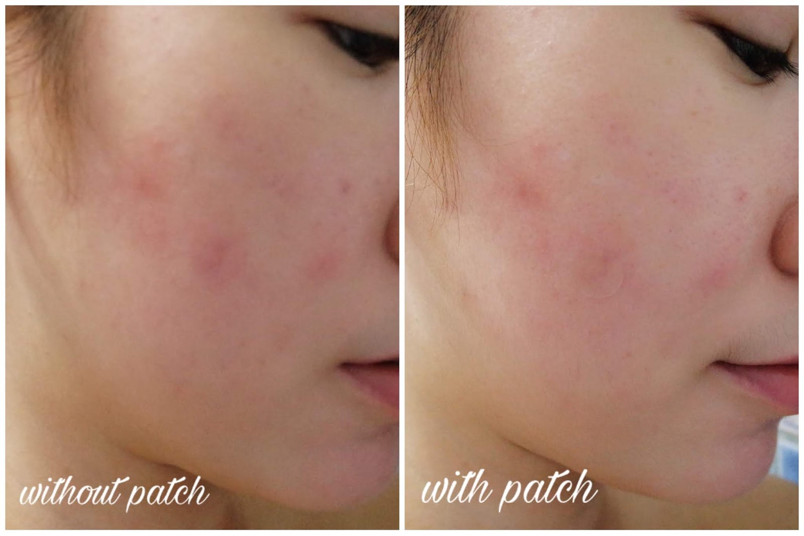 A.stop Spot Treatment and Care Patch Review | pinkislovebynix