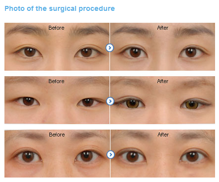 ID Hospital Korea: Double eyelids with the different left and right sides