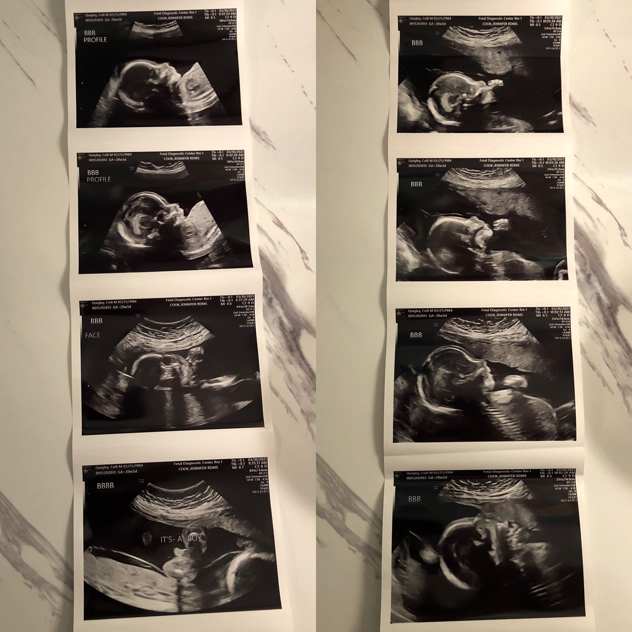The Stork 2020: 20 week Anatomy Scan Ultrasound! 3/10/2021