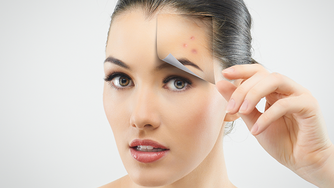 EXISTEN DIFERENTES TIPOS DE ACNÉ Y DEBEN SER TRATADOS DE MANERA DIFERENTE.