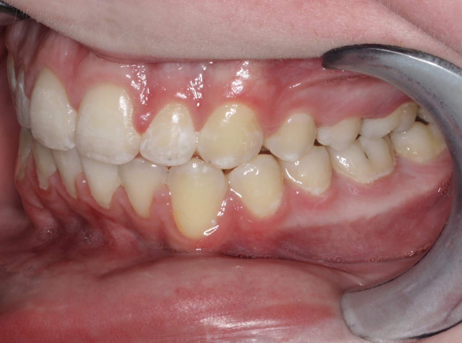 Weiler Orthodontics: Deep Overbite Correction