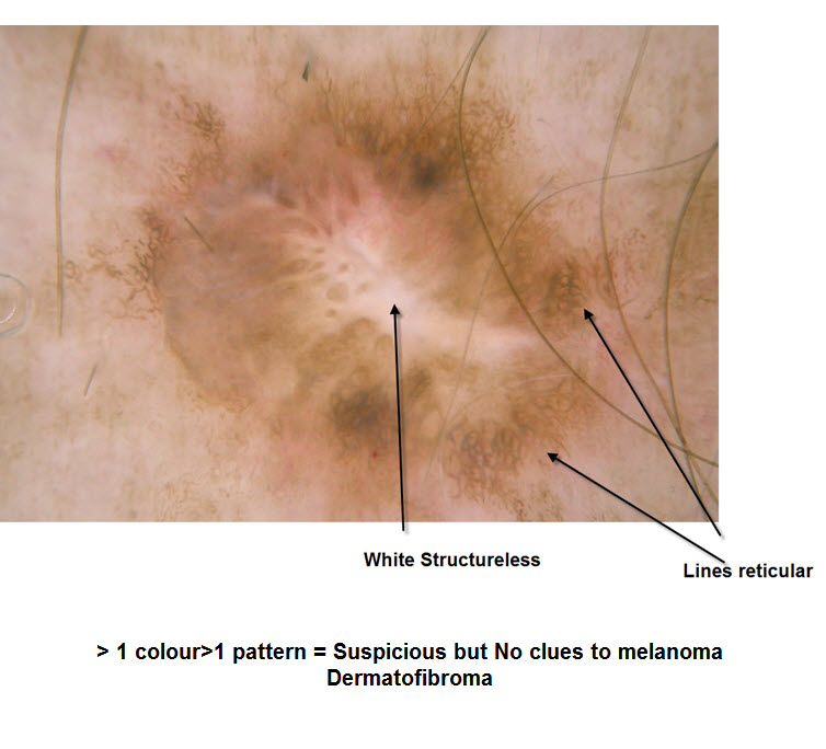 Dermoscopy Features as Clues: Lines Reticular