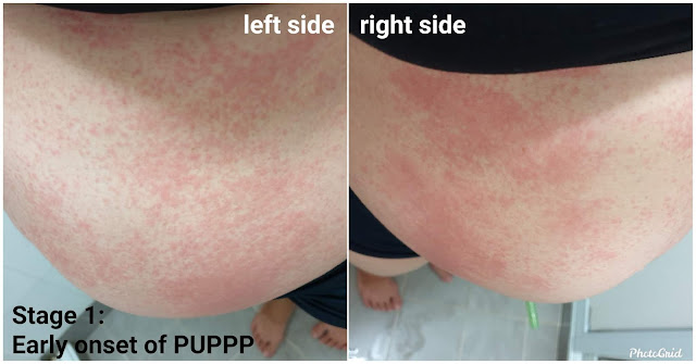 secondchance : PUPPP rash of pregnancy - What worked for me