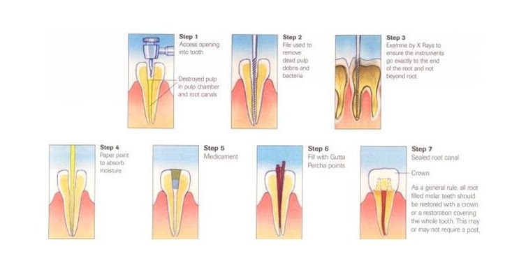 Thasinawoyo Bobane: Mengapa Gigi Harus Dilakukan Perawatan Saluran Akar
