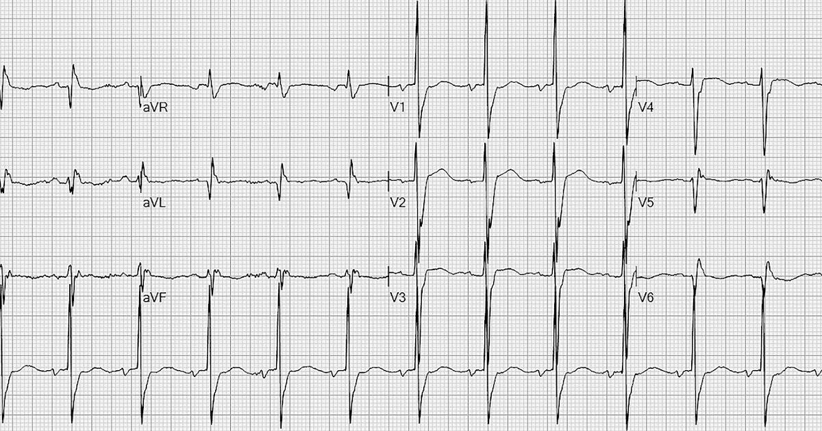 Focus on ECGs: Case #20 — Tall R Waves in Precordial Electrocardiogram ...