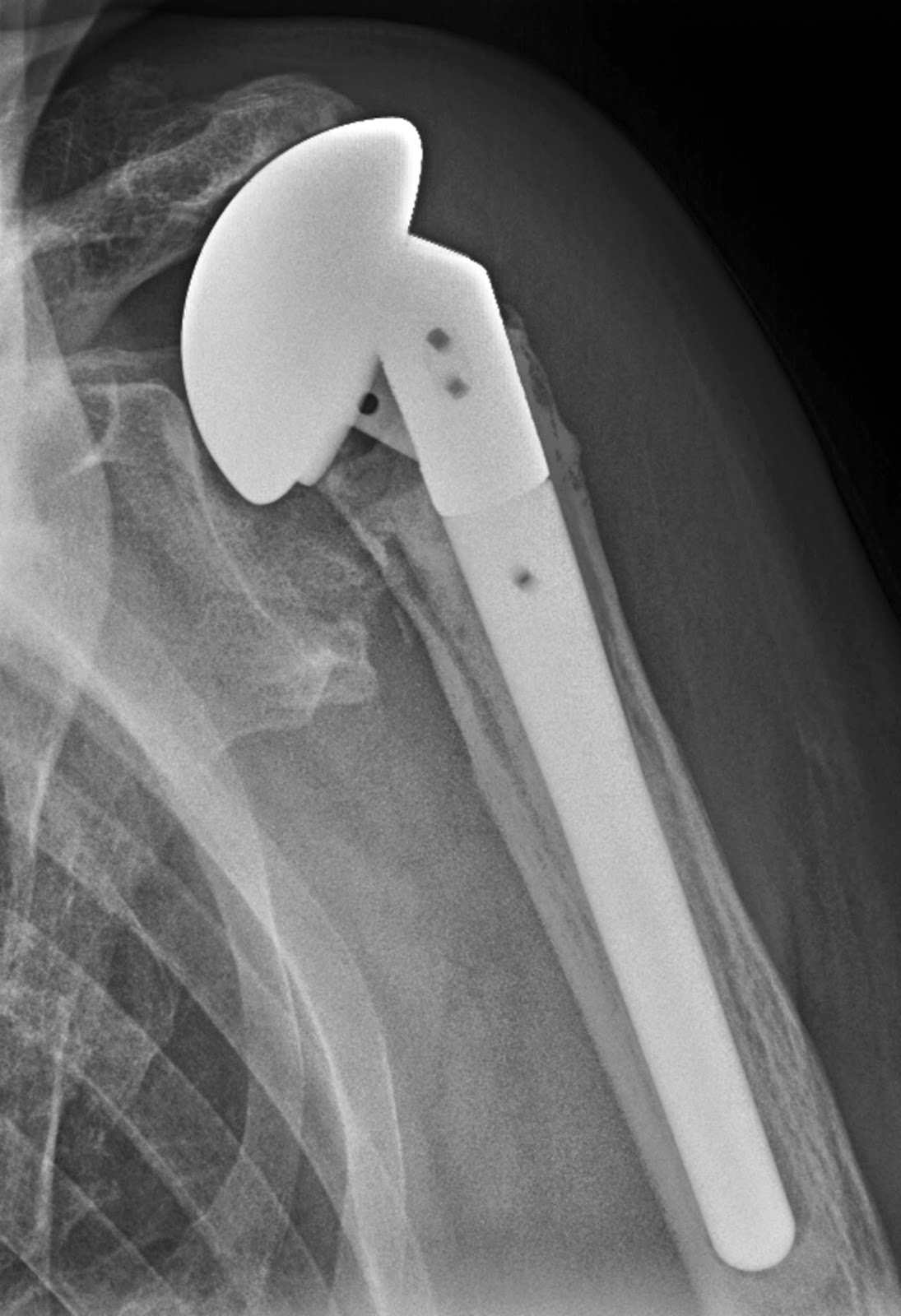 UW Shoulder and Elbow Academy: Failure of anatomic total shoulder joint ...