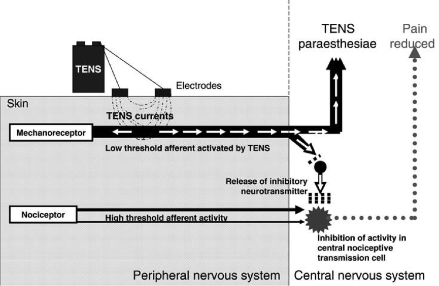 Electrical Stimulation for Cancer Patients: Types of TENS: