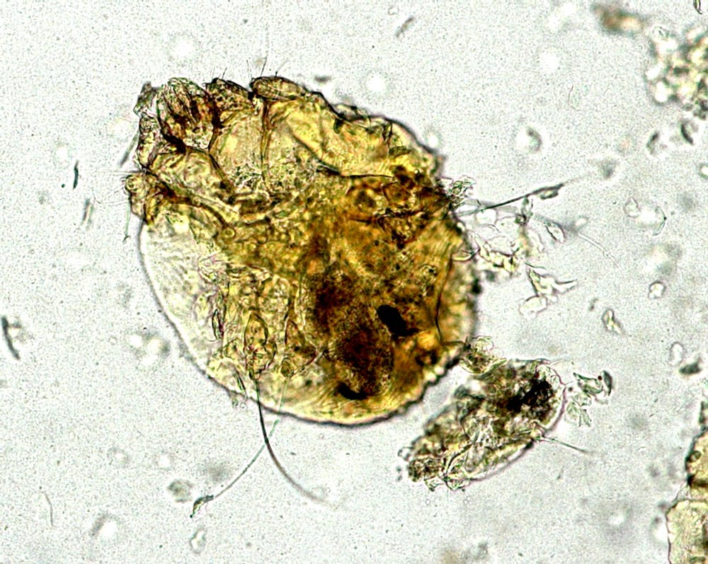 La gale et sa contagion rapide ~ Info Gale