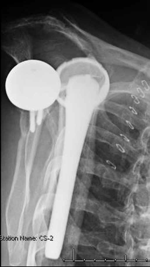 Shoulder and Elbow Surgery: Dislocation of reverse shoulder replacement ...