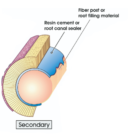 Monoblock in Endodontics [Detailed Explaination with Studies]
