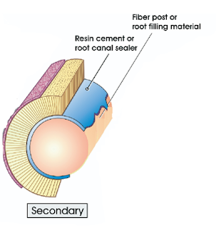 Monoblock in Endodontics [Detailed Explaination with Studies]