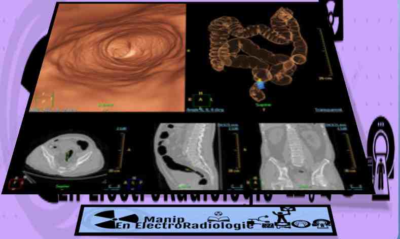 COLOSCANNER MEILLEUR EXPLICATION