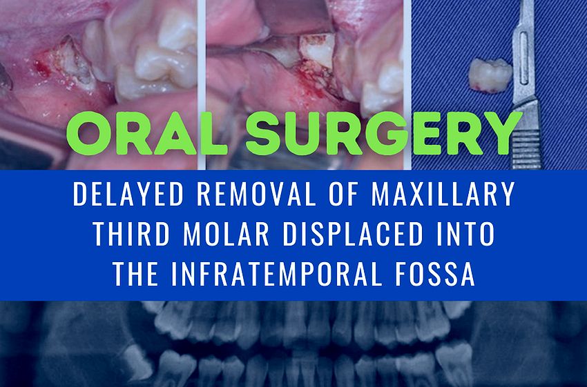 PDF: Delayed removal of maxillary third molar displaced into the ...