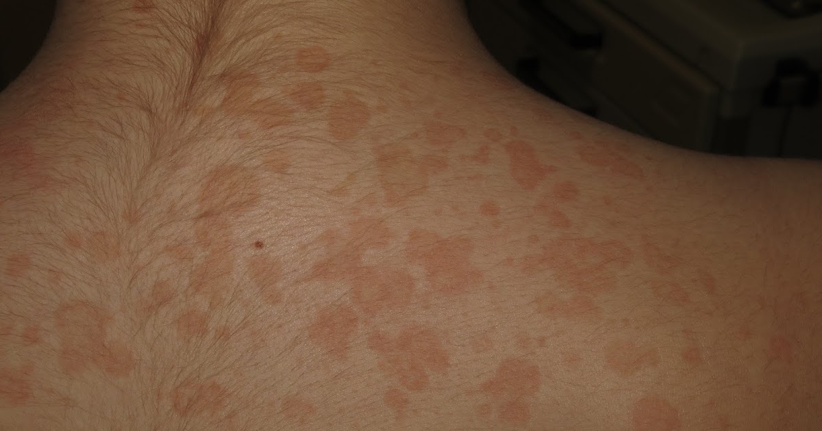 Dermapixel: Pitiriasis versicolor: el hongo que no se contagia