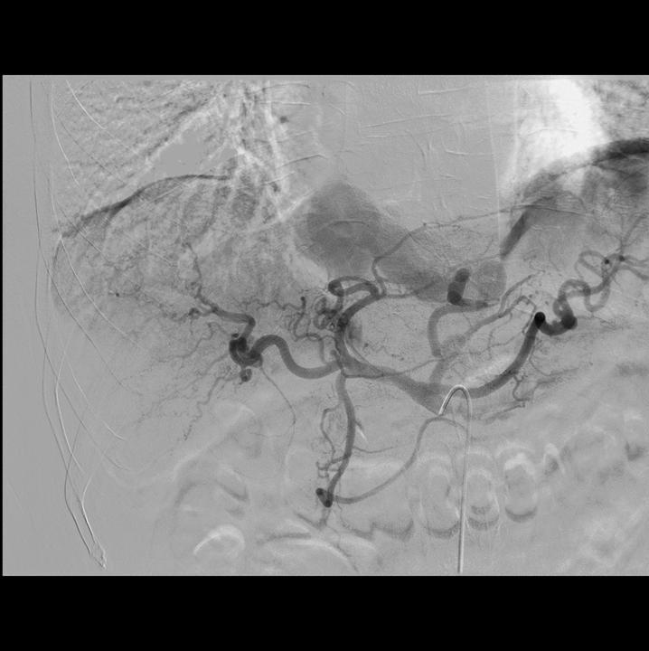 The Pump and the Tubes: Middle Hepatic Artery