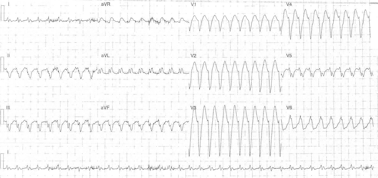 ECG of the Week: ECG of the Week - 13th August 2018 - Interpretation