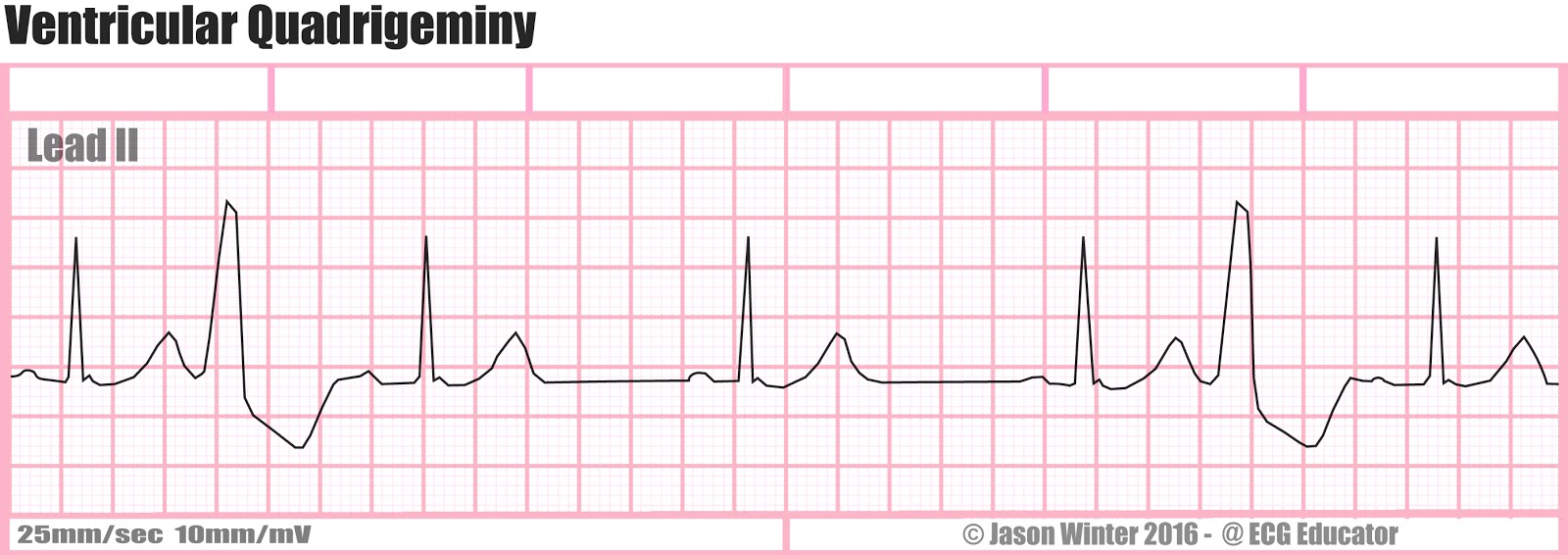 ECG Educator Blog : Six Second ECG Rhythm Strips
