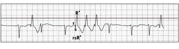 ECG Rhythms: Aberrancy