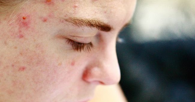 What Is Acne? – Causes And Home Remedies To Cure Acne