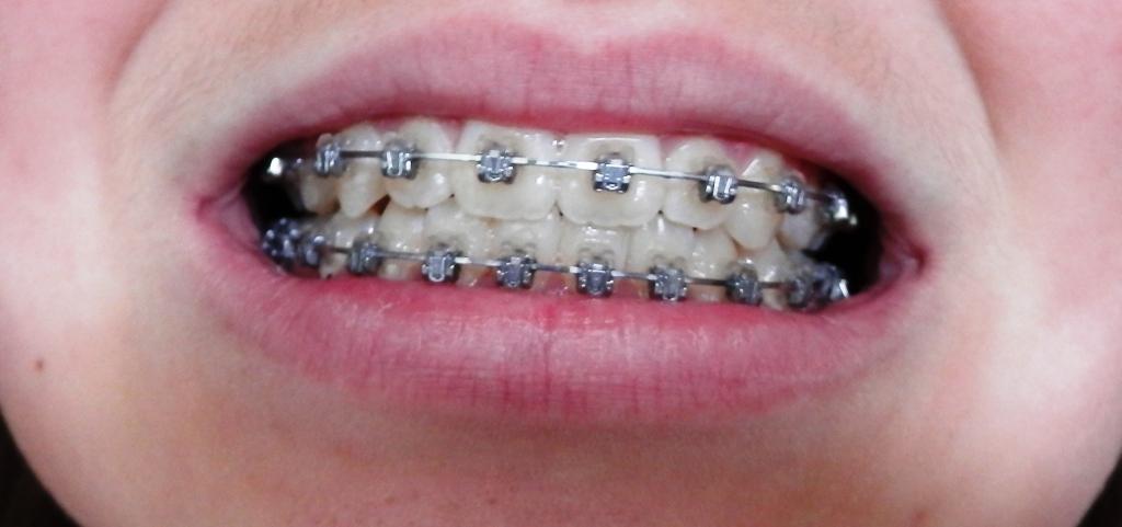 Life in Rural Japan: Braces part 2