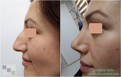 Health Zone Turkey: Nose Job in Istanbul, Turkey