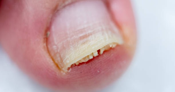 Psoriasis y su afectación en los pies