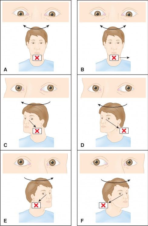Vestibular Rehabilitation