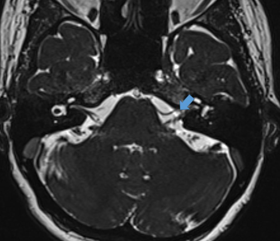 Iac Mri Anatomy