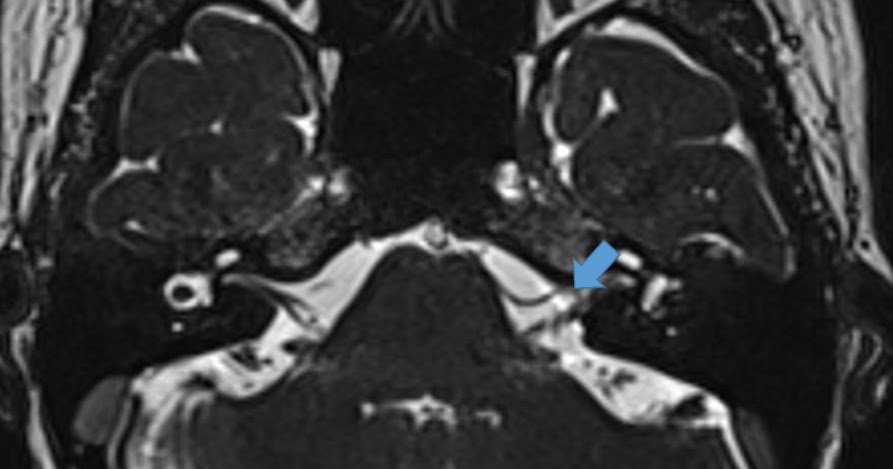 Ultimate Radiology : Vascular loops in Internal Acoustic Canal (IAC)