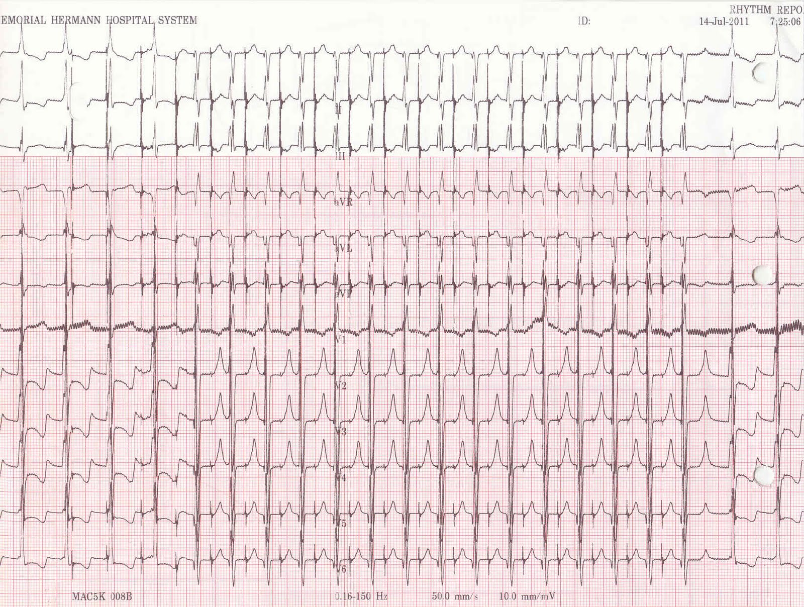 Pedi cardiology: EP, ICU: Junctional Tachycardia vs. Ventricular ...