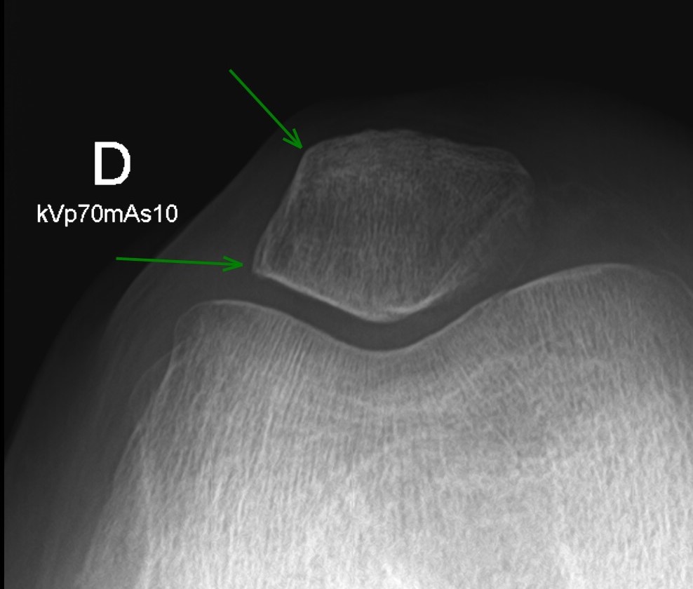 Partial Lateral Patellar Facetectomy.