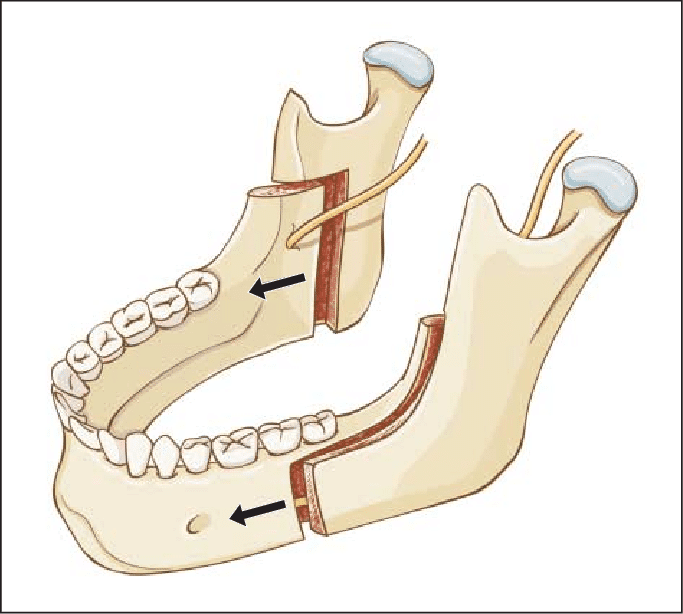 Bilateral Sagittal Split Osteotomy