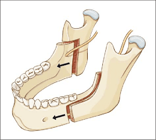Bilateral Sagittal Split Osteotomy