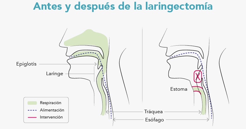 Blog de Voz: TRATAMIENTO EN PACIENTE LARINGECTOMIZADO