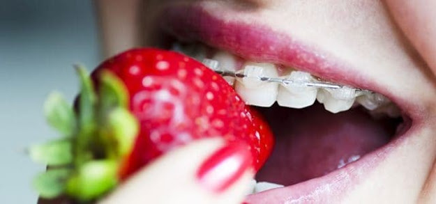 ¿QUÉ ALIMENTOS CONSUMIR CUANDO ESTAS USANDO BRACKETS?