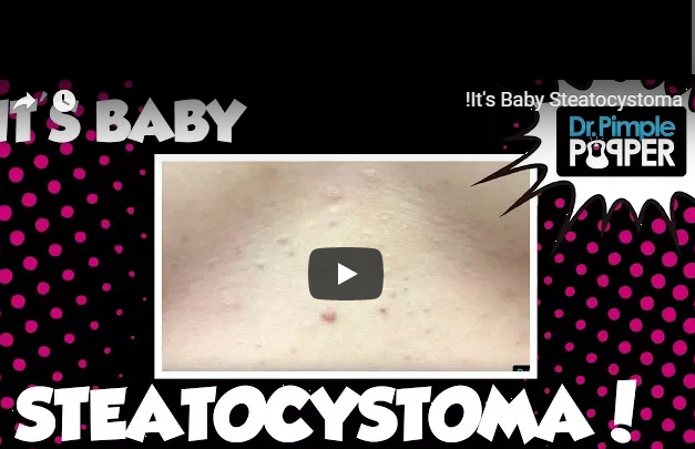 It's Baby Steatocystoma! - dr pimple popper