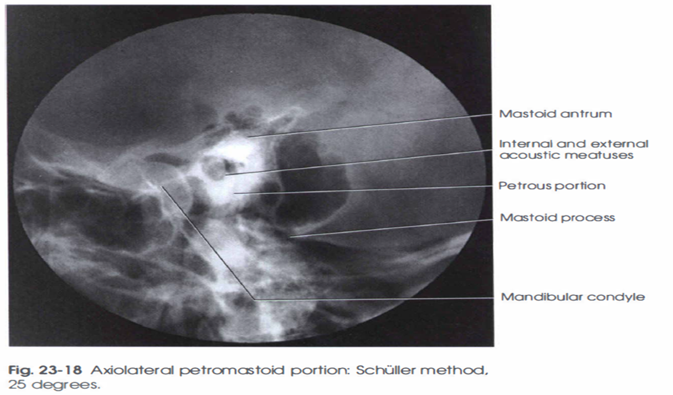 Catatan Ku: Teknik Radiografi Mastoid