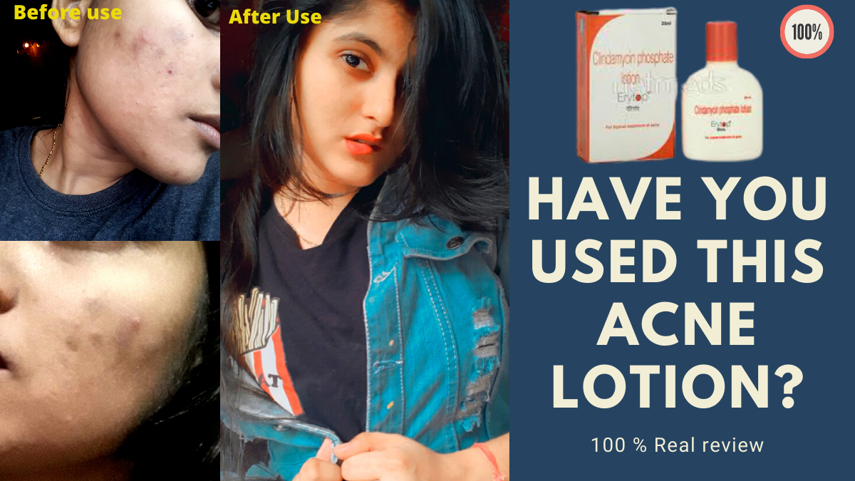 Erytop lotion review | Erytop | Clindamycin phosphate lotion for ...