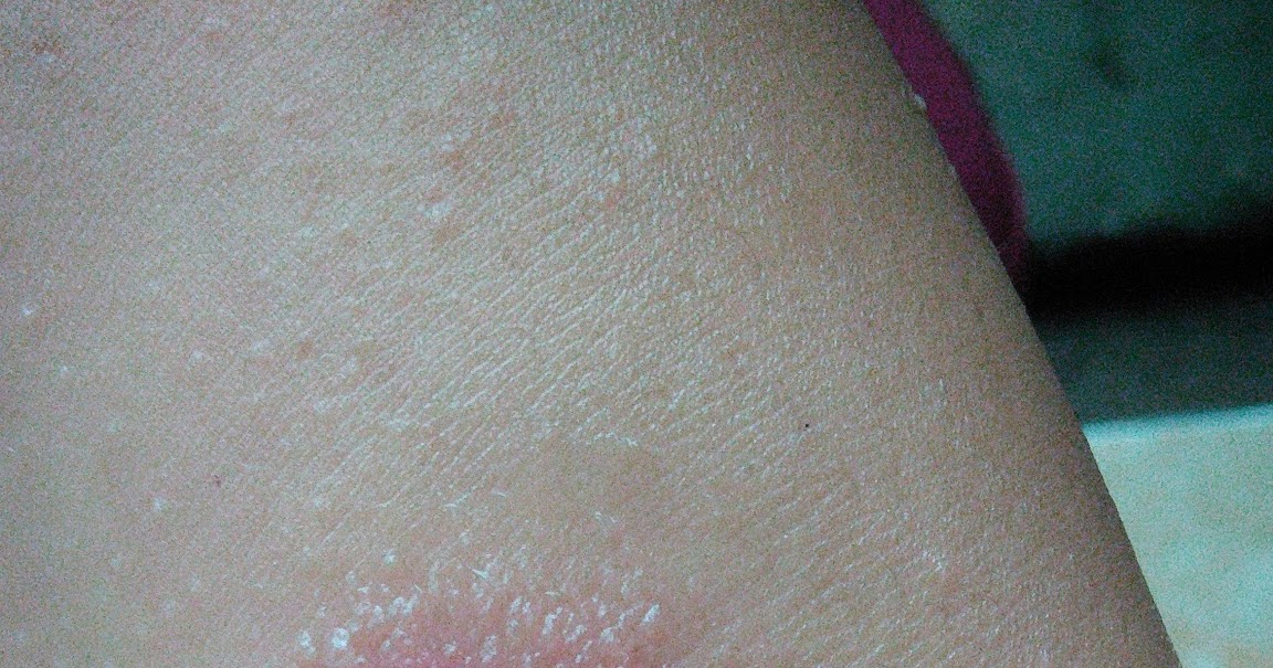 Marsela Blog: Mengatasi Gigitan Tomcat