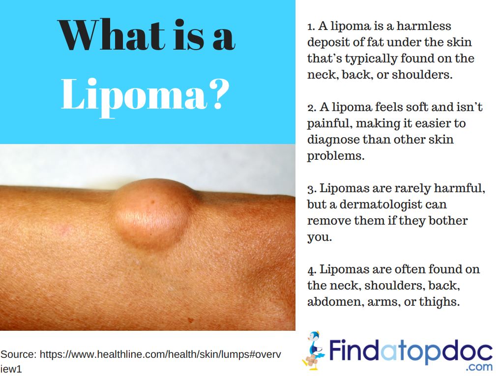 FindaTopDoc Blog: What is a Lipoma: Symptoms